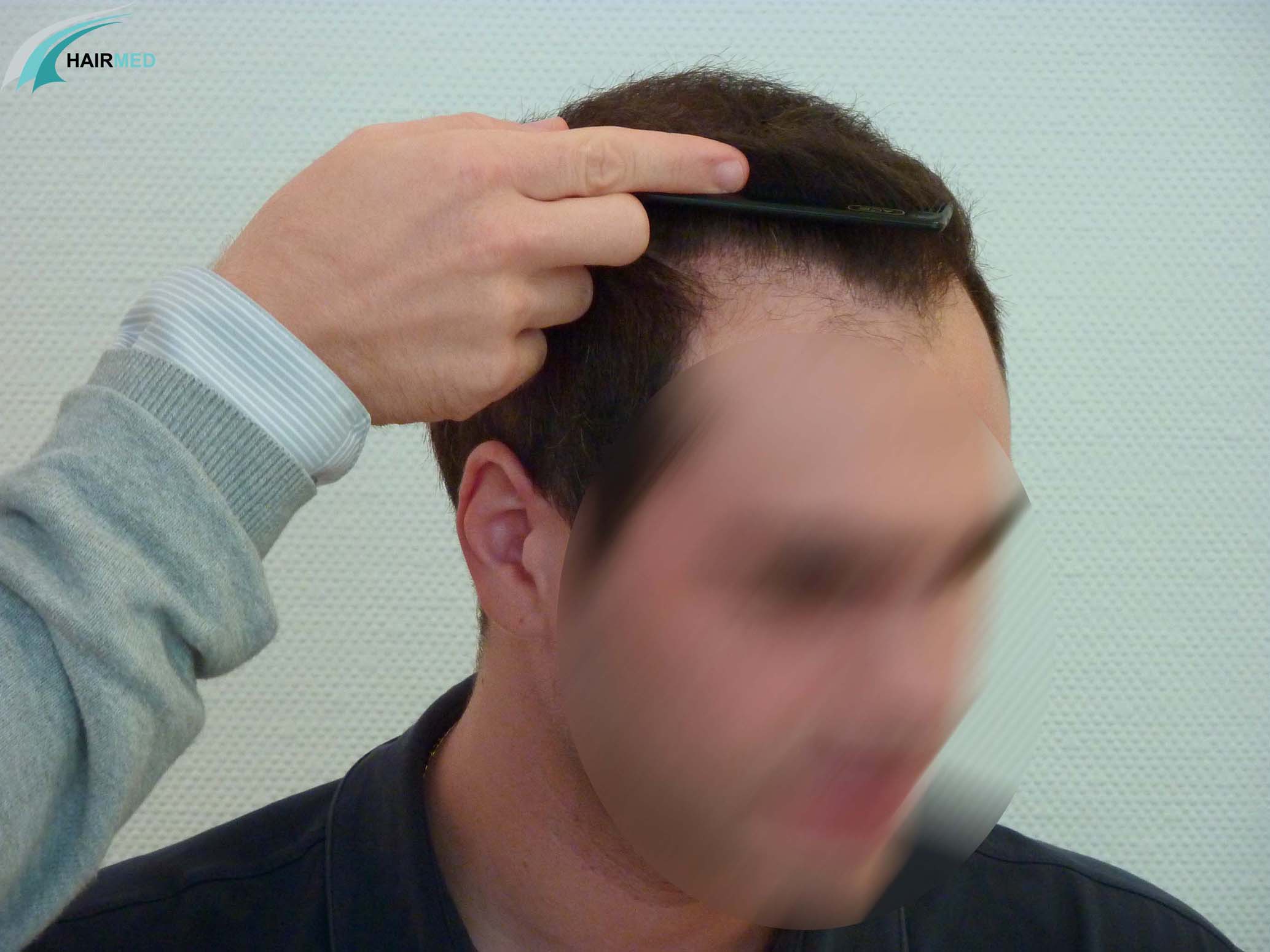 After Fue Istanbul Hair Transplant Dr Beyhan 4000 Grafts Copy Hairmed